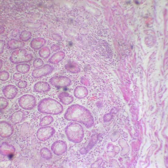 Cole-Parmer Prepared Slide, Human Stomach Tissue, Ulcer Cells from Cole ...